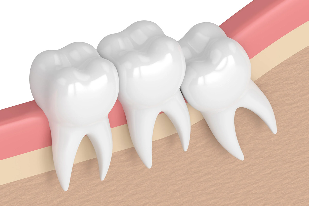 Extracción de Cordales en Puerto Rico | LMA Cosmetic, Oral ...
